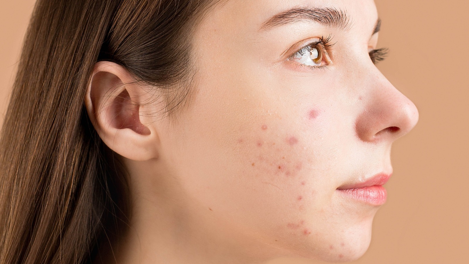 Notícias | Tratamento para acne severa viraliza conheça opções | Portal ...