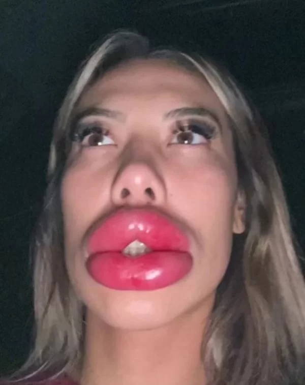 Mulher tem reação alérgica a preenchimento e resultado é assustador ...