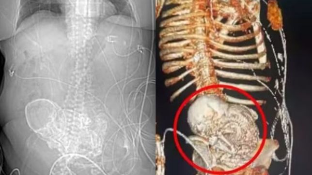Notícias | 'Bebê de pedra': idosa descobre feto calcificado que ...